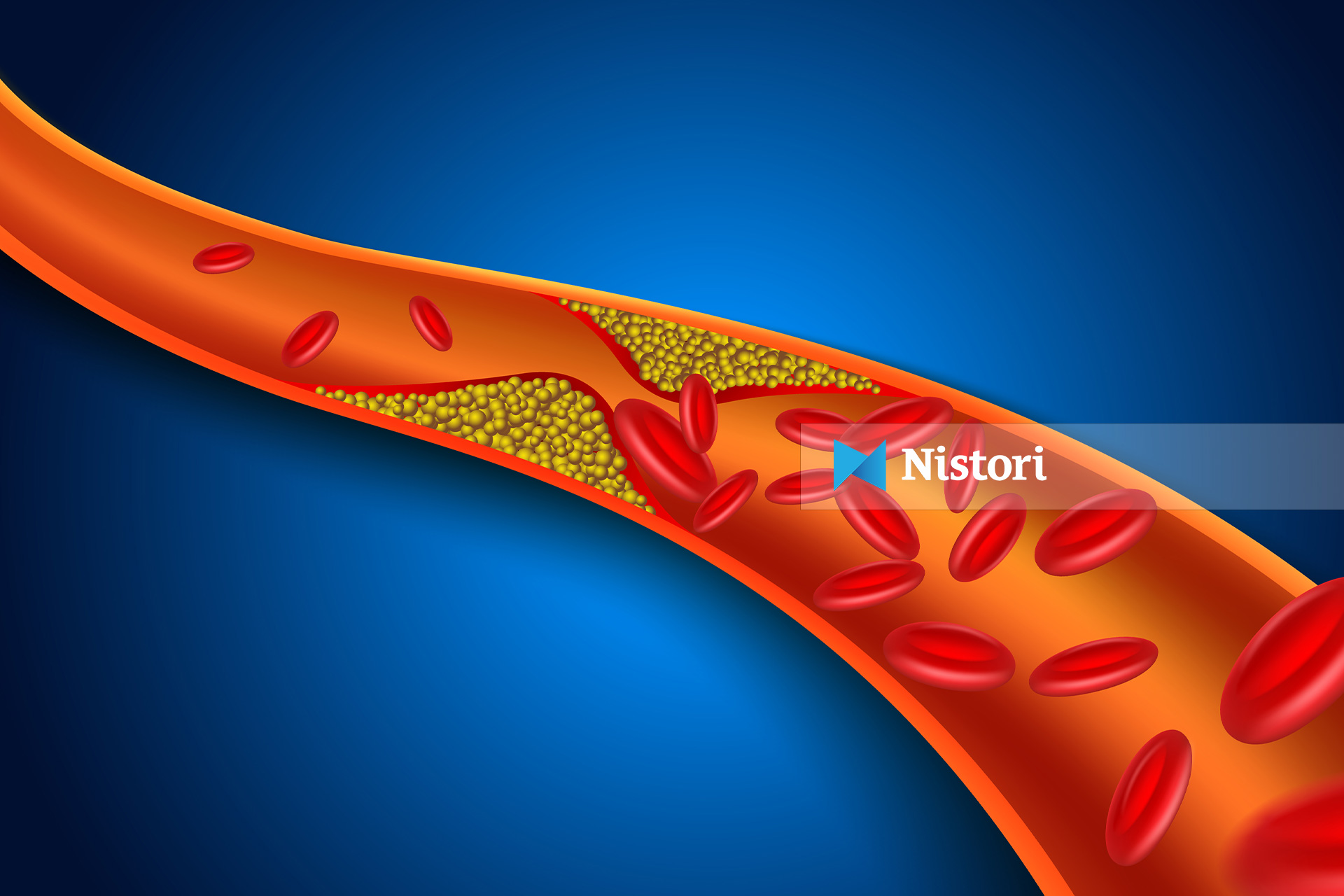 Çfarë është yndyra e barkut? – Nistori